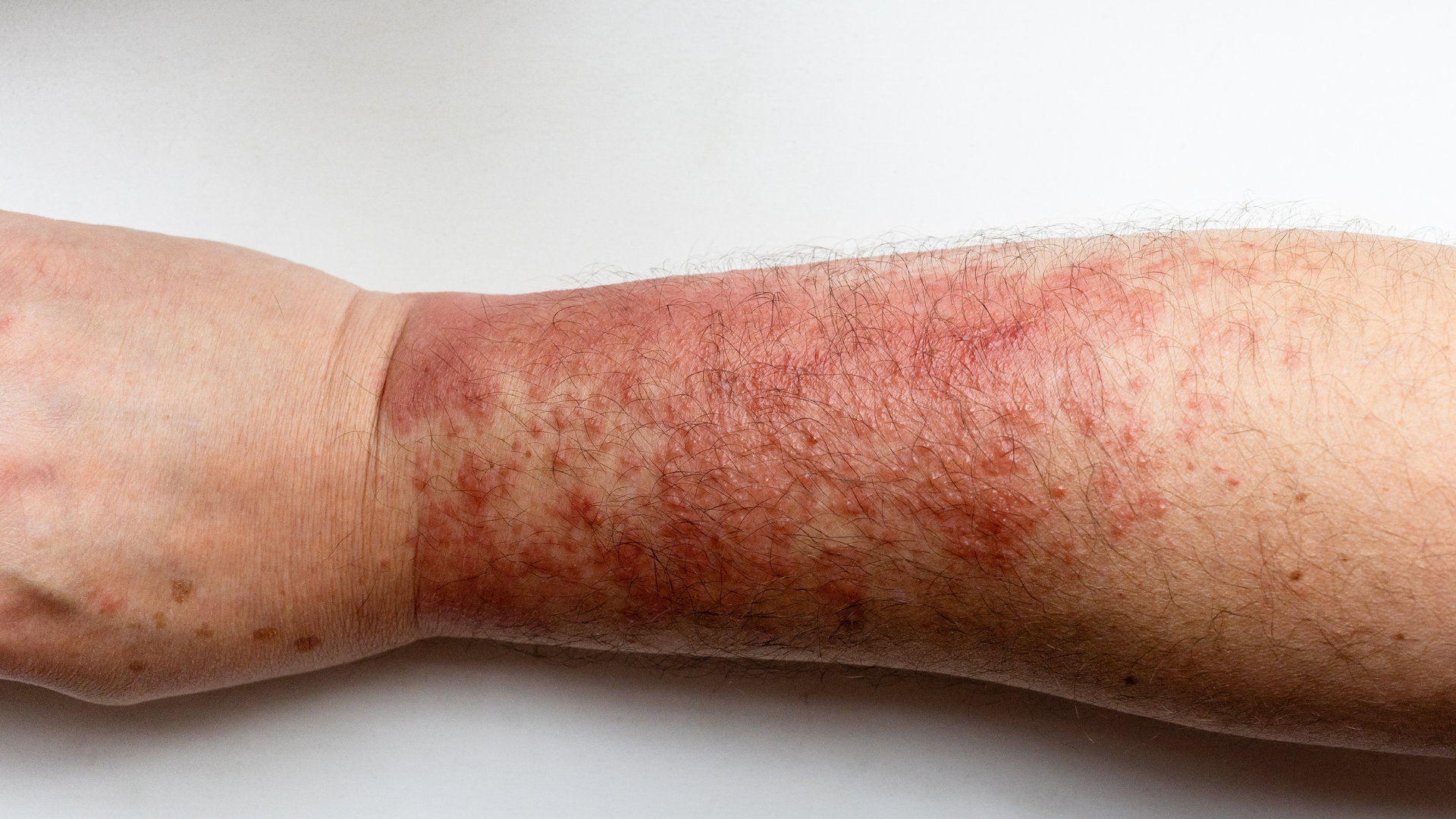 Dermatitis Atopi: Definisi, Gejala, Faktor Risiko, Pengobatan, dan Cara ...